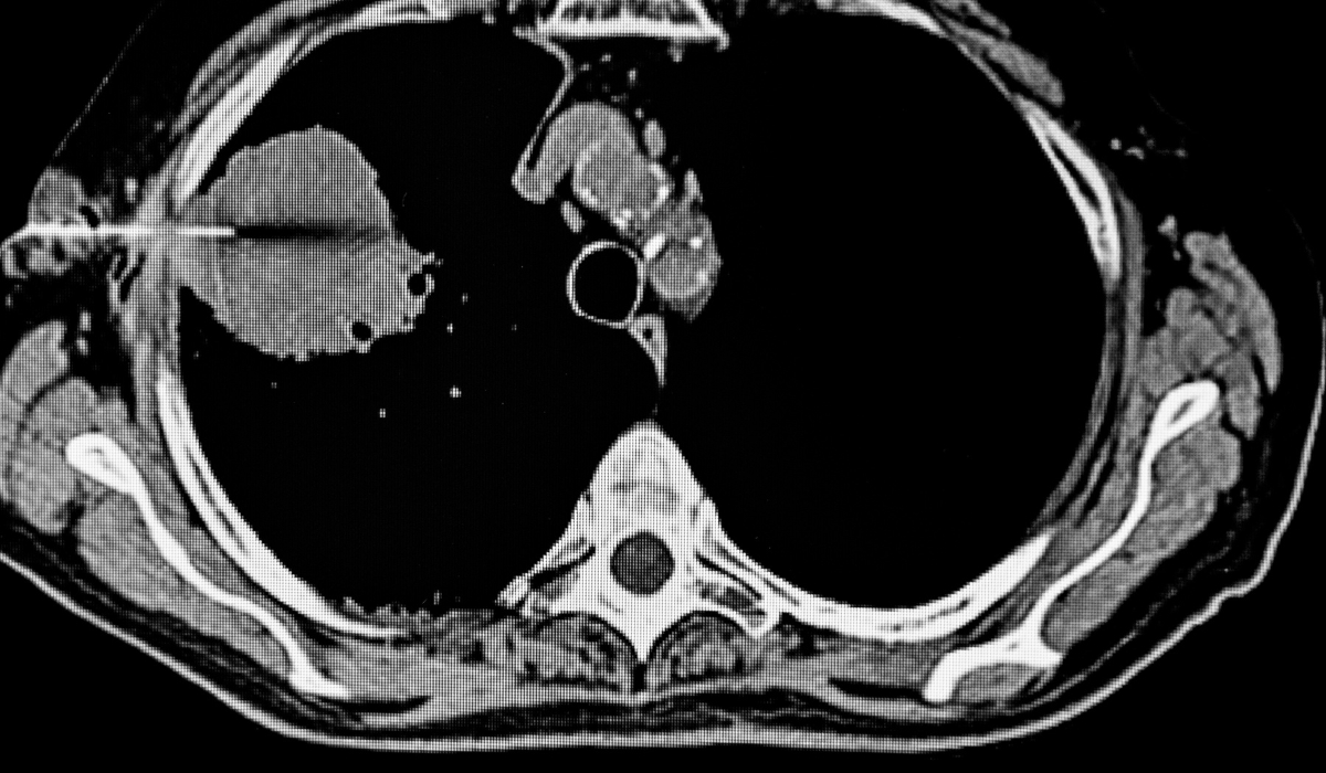 Achieving targeted intratumoural drug delivery