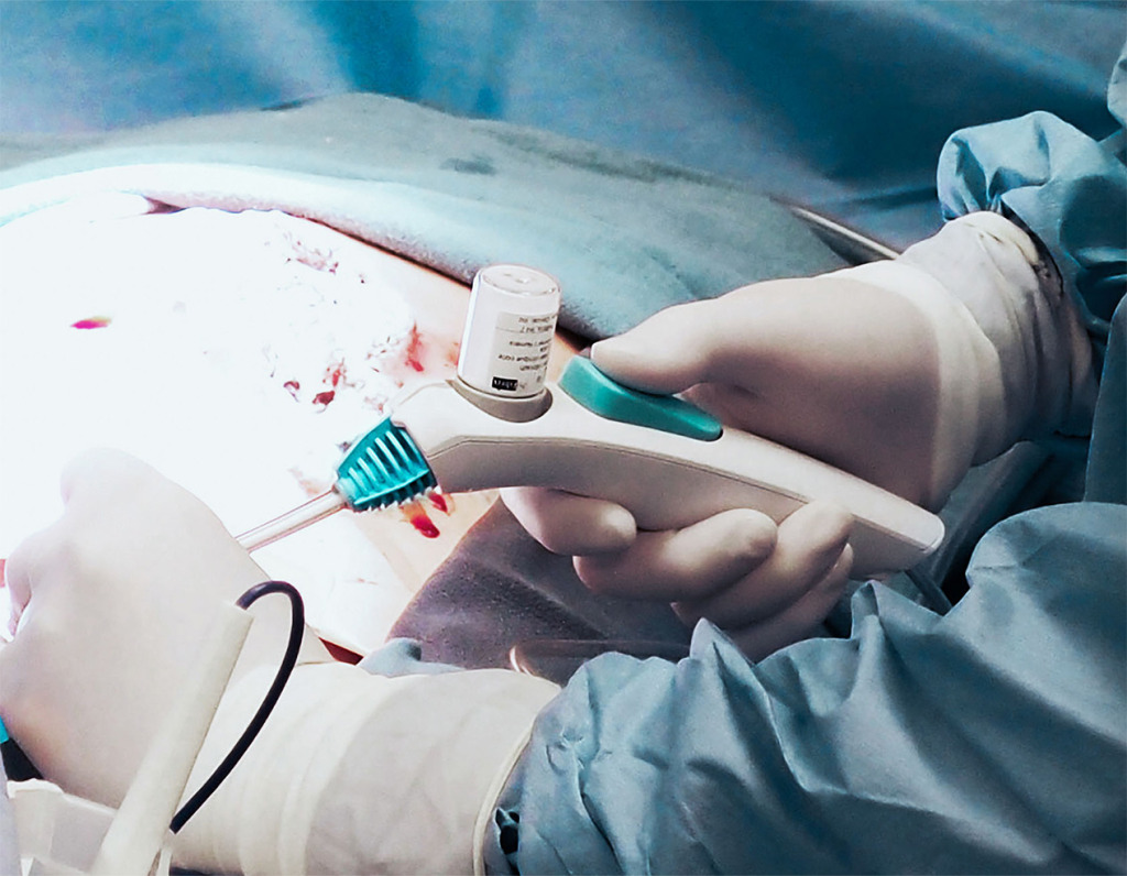 Surgical Bleeding Control Device Development | Team Consulting