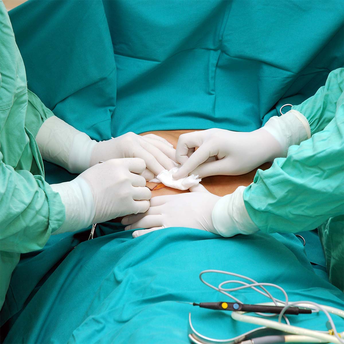 Controlling breast surgery incisions | Team Consulting